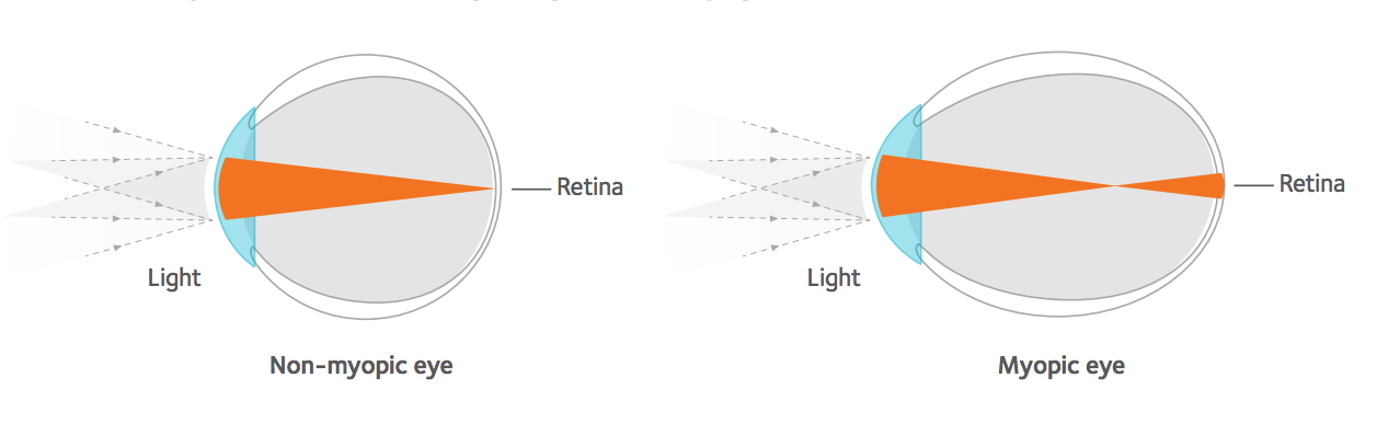 Myopia Management @ Coal Creek Family Vision - Newcastle, WA